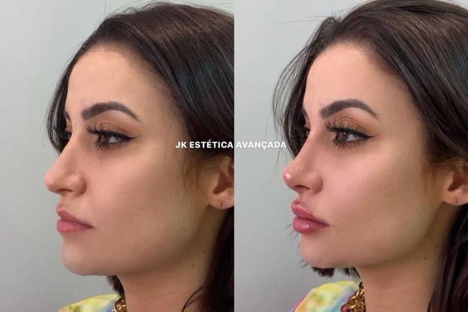 Veja como ficou o rosto de Boca Rosa após harmonização facial | Metrópoles