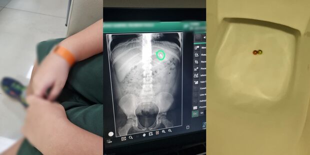 Criança de 8 anos engole bolinhas de imã em Campo Grande (MS) | Metrópoles